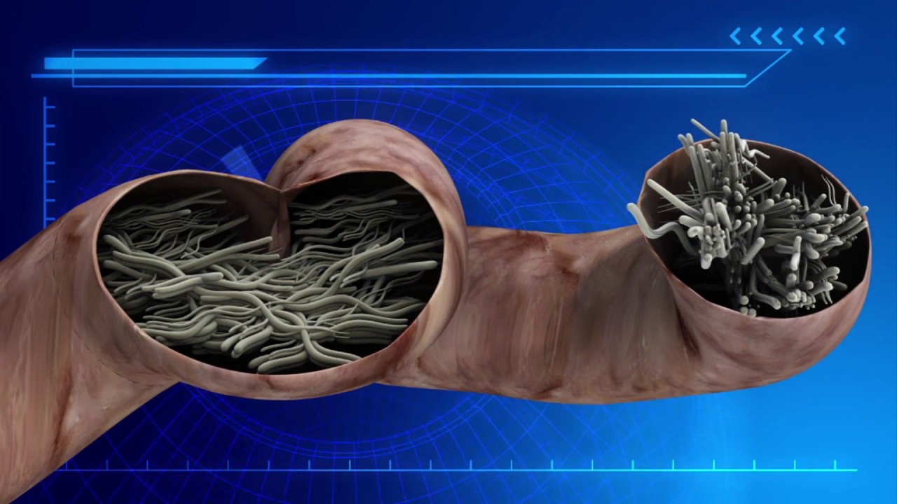 North Korean defector's stomach is full of parasites - YouTube