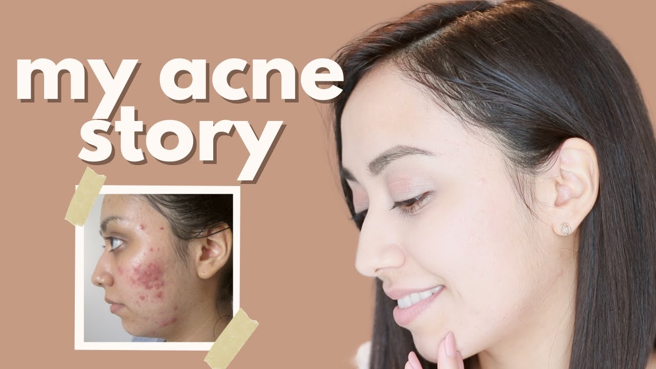 My Acne Story Journey To Clear Skin Part 1 3 Youtube
