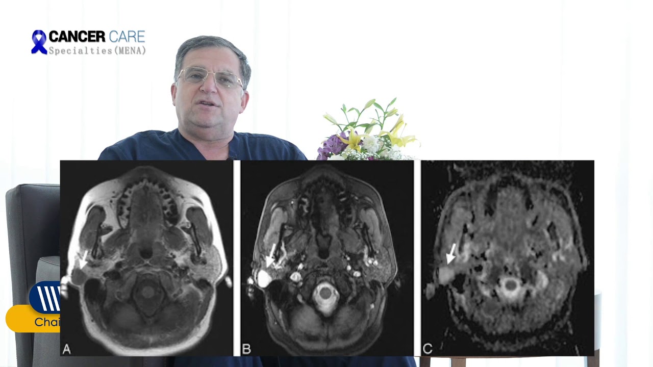 Parotid Tumors in UAE - Dr. Sadir Al Rawi - YouTube