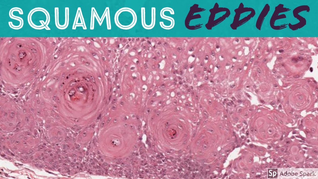 Irritated Seborrheic Keratosis (w/ Squamous Eddies): 5-Minute Pathology ...