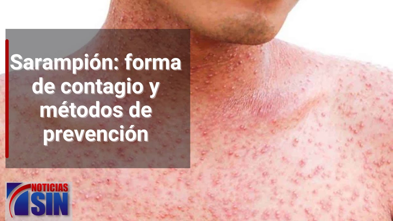 Sarampión: forma de contagio y métodos de prevención - YouTube