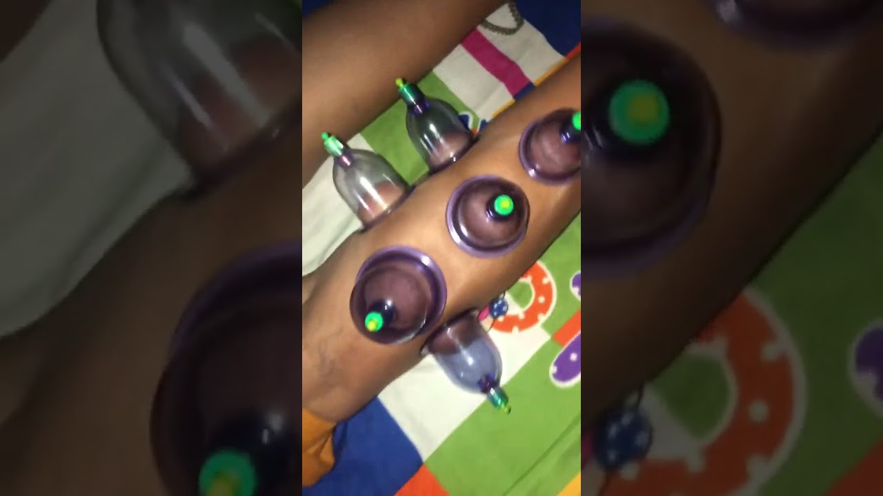 Cupping therapy for calf with movement #pain #physiotherapy #docter ...