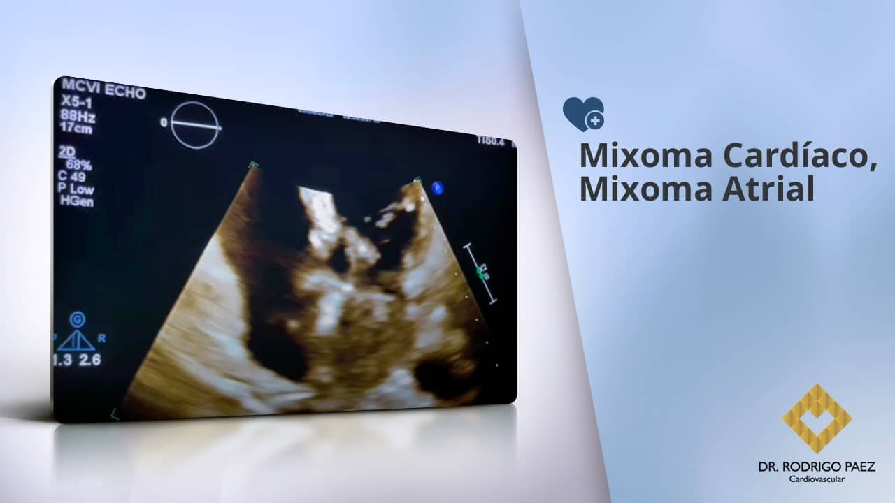 Mixoma cardíaco, Mixoma Atrial - YouTube