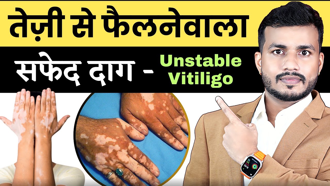 Vitiligo Ayurveda Dosha at Shanita Parker blog