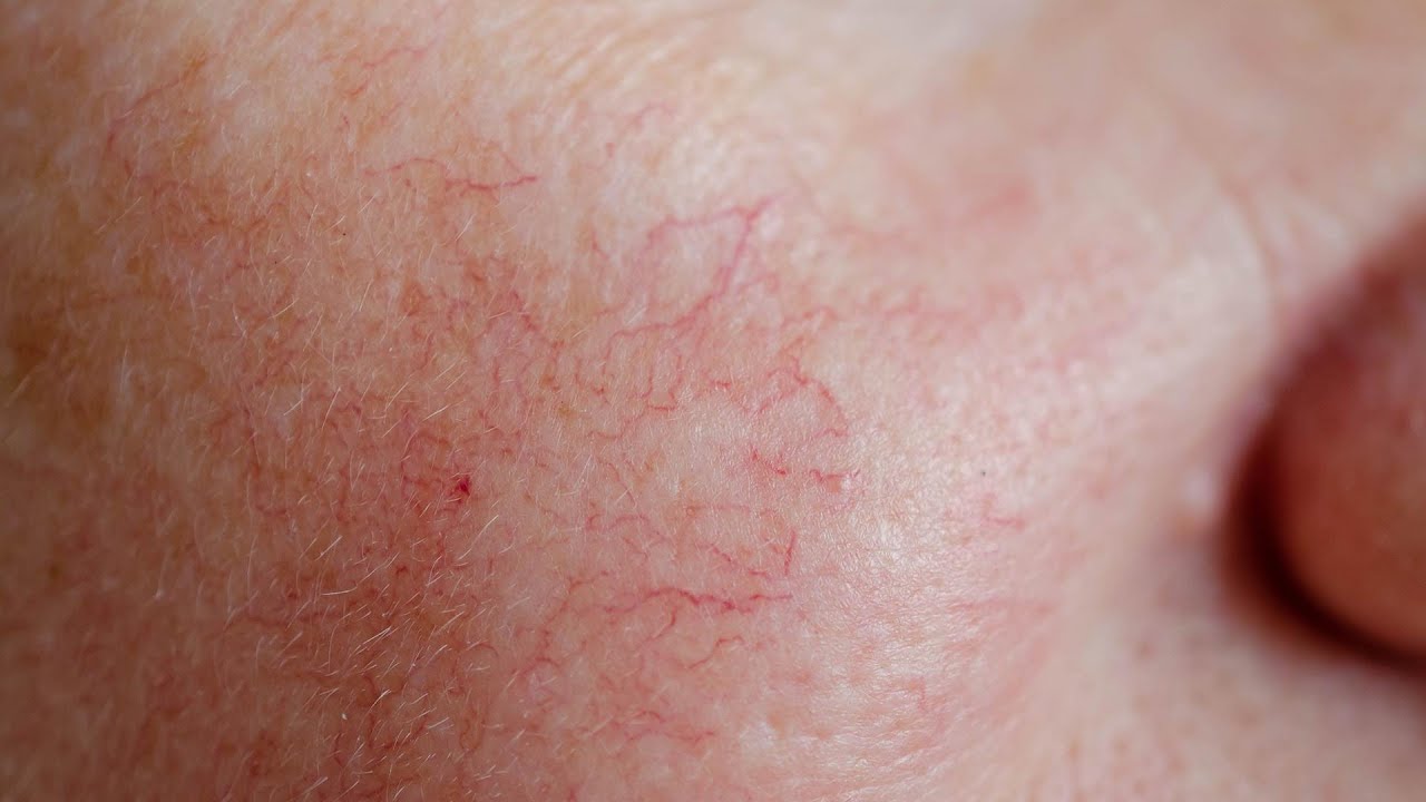 How To Calm Skin Redness In a Pinch With Nasal Spray | Dr. Pimple ...