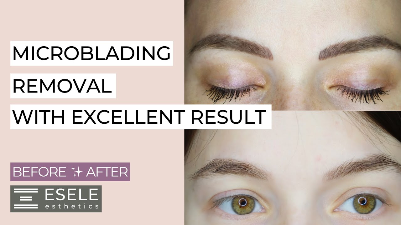 How to Remove Microblading? Tattoo Removal. Low-Quality Permanent ...