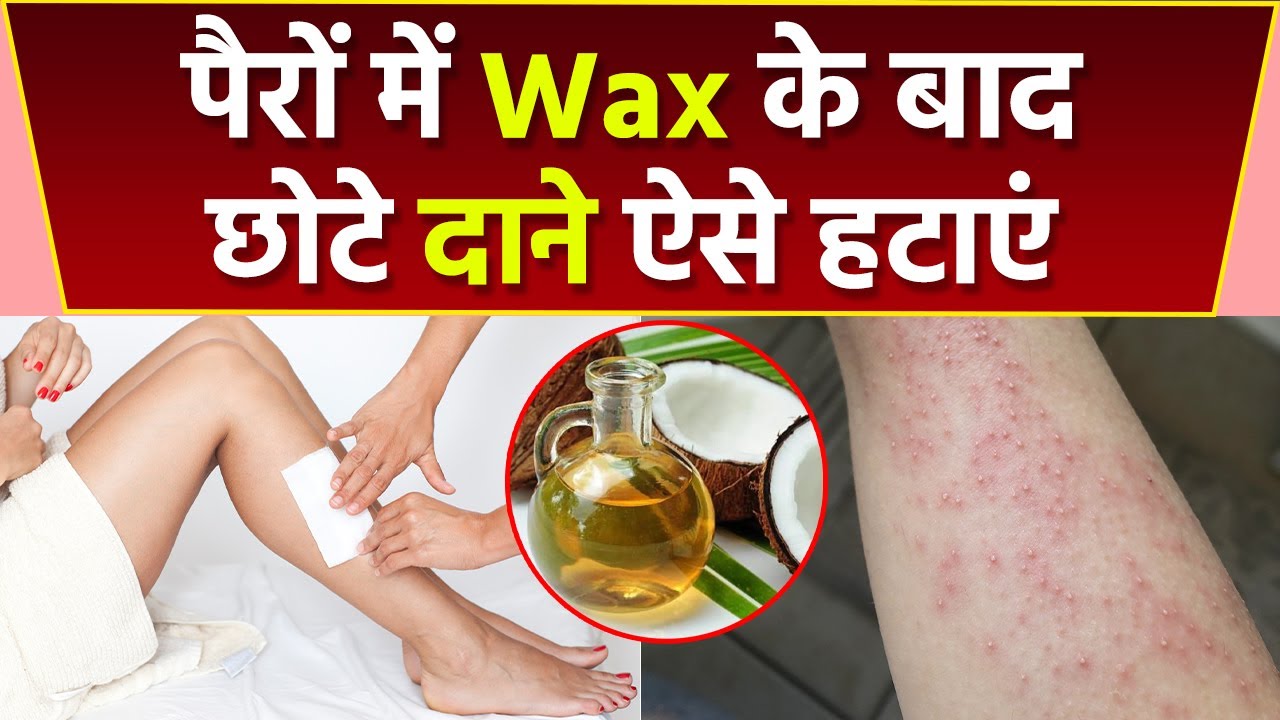 पैरों पर Waxing के बाद छोटे दाने आने के बाद करें ये उपाय, Waxing के बाद ...