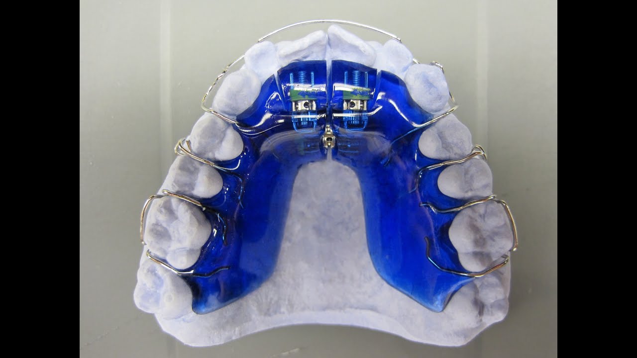 Labialbogen Labial Arch KFO Kieferorthopädie Orthodontics - YouTube