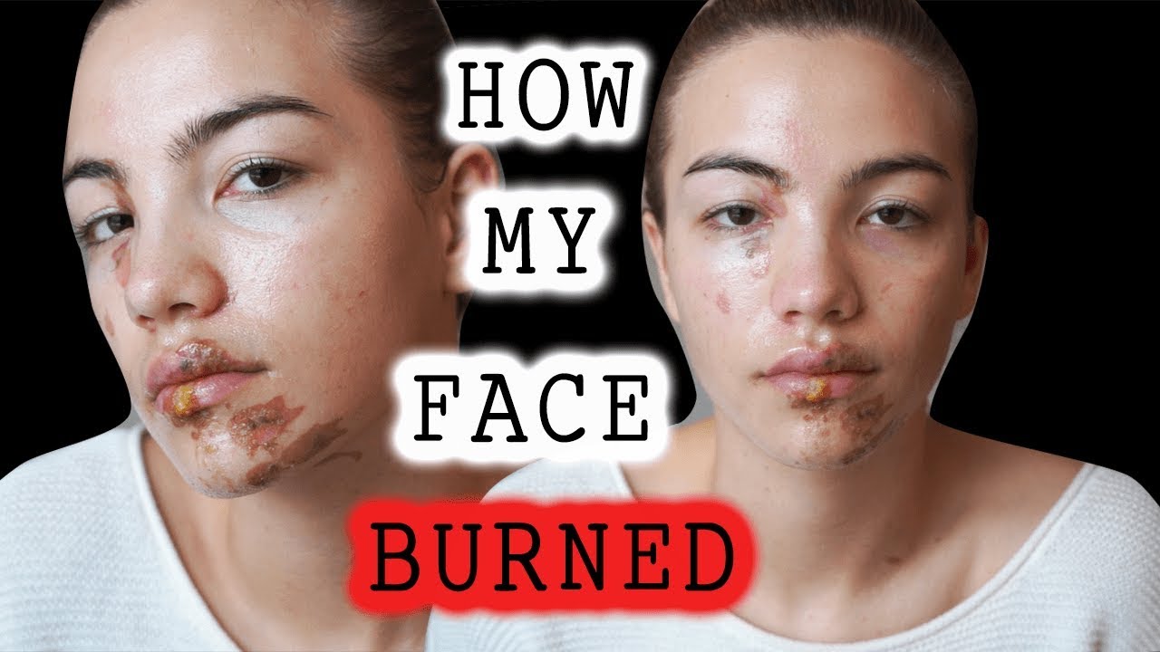 WHEN LIFE GETS YOU DOWN | STORY TIME OF HOW MY FACE BURNED AND HOW I'M ...