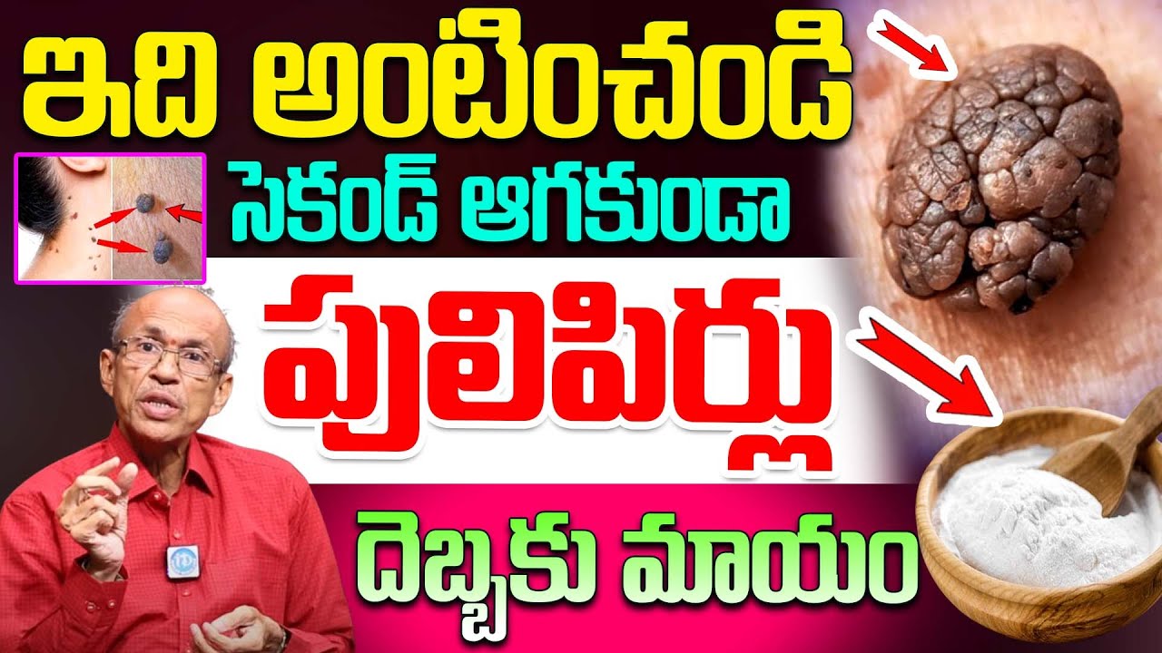 నొప్పి లేకుండా పులిపిర్లు మాయం | Home Remedies For Pulipirlu ...