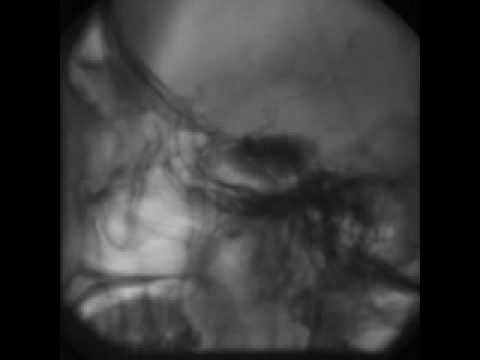 Interventional Radiology : Ballon embolization in the carotid cavernous ...