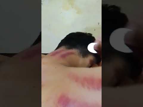 KEROKAN LEHER REMAJA (5)