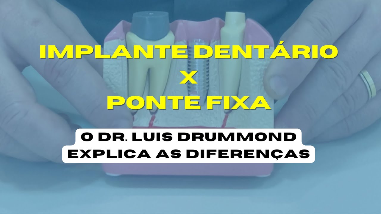 Ponte Fixa x Implante Dentário: qual diferença entre estes dois ...
