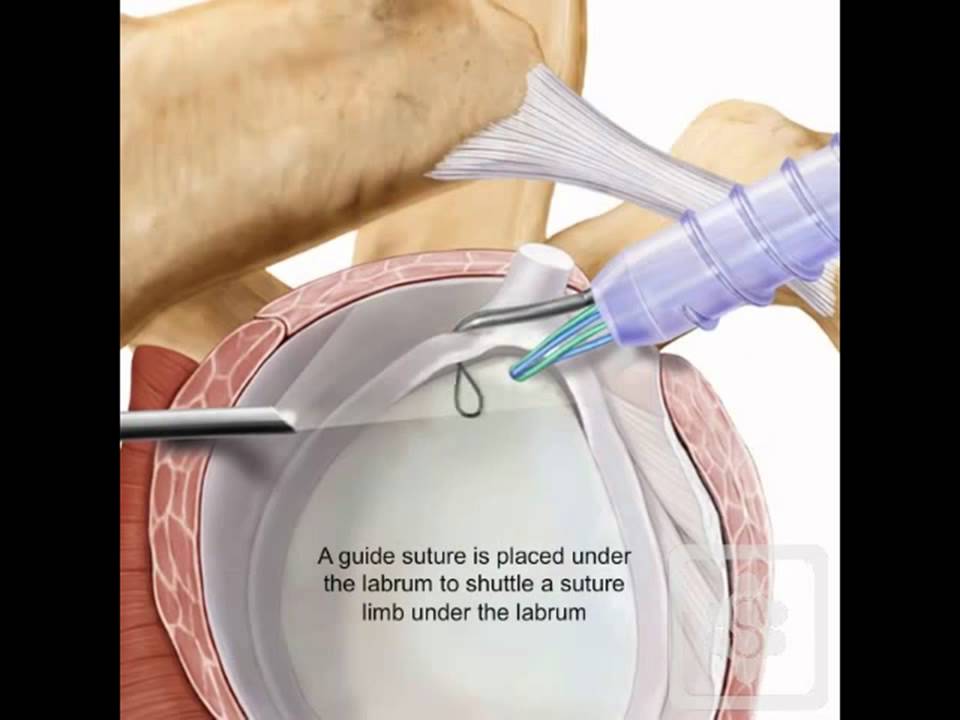 SLAP LESION - LESIONE SLAP ANIMAZIONE 3D (www.lachirurgiadellaspalla ...