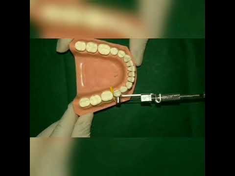 TOFFLEMIRE MATRIX BAND SETUP AND PLACEMENT - YouTube