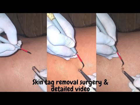Skin tag removal by cautery || Procedural & detailed video in hindi ...