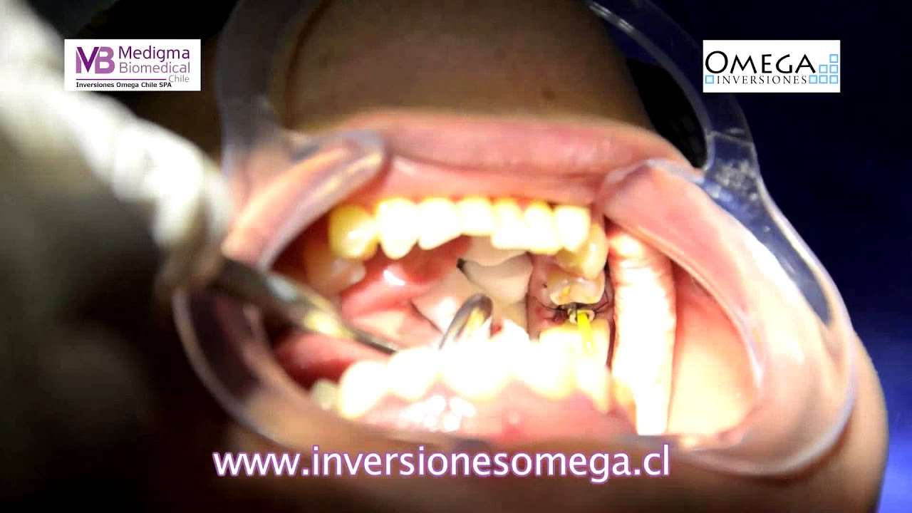 Implantes Medigma instalados en Clínica Smile Design - YouTube