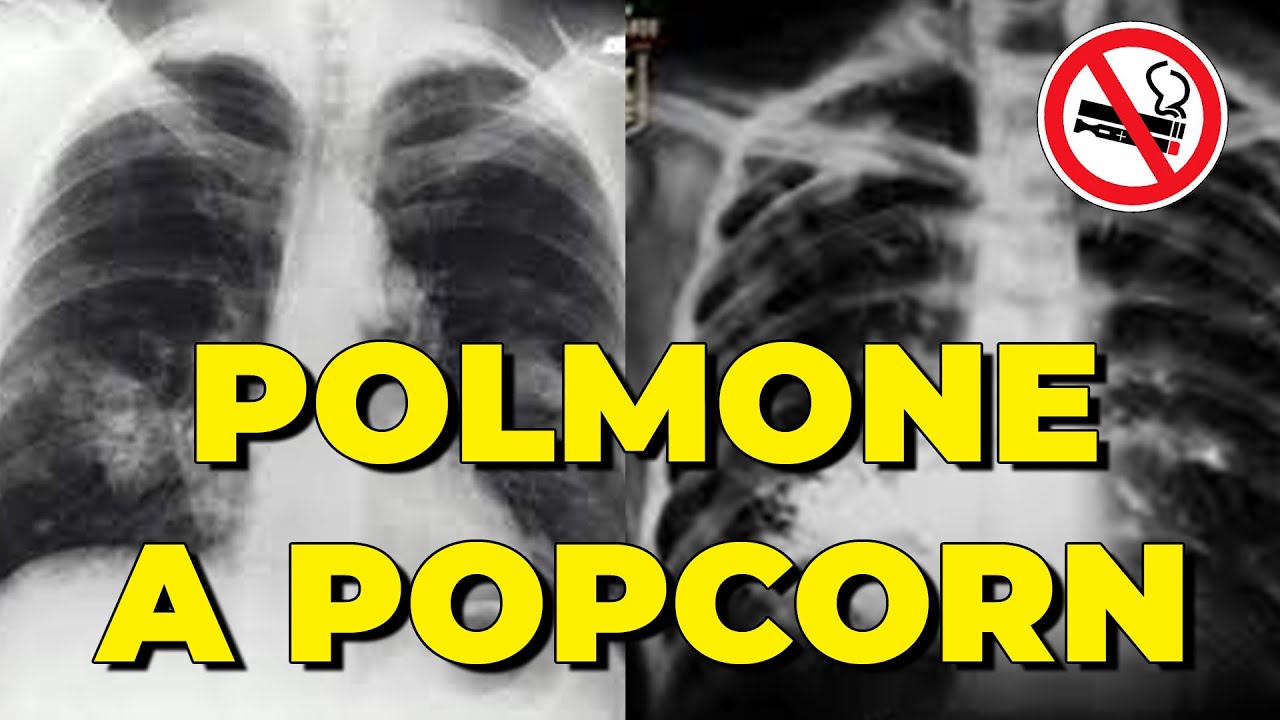 POLMONE A POPCORN da Sigaretta Elettronica - YouTube