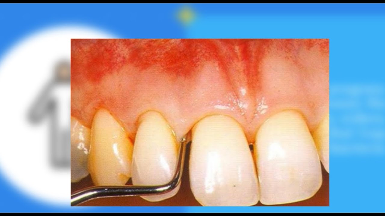 From Gingivitis to Advanced Periodontitis: The Stages of Gum Disease ...