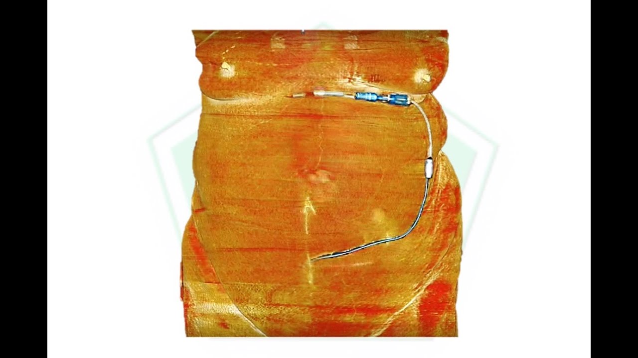 Catéter Tenckhoff - Dialisis Peritoneal - YouTube