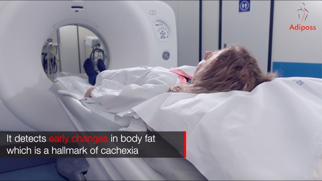Early detection of cancer cachexia - YouTube