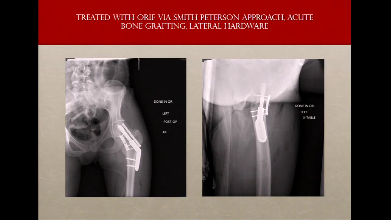 Avoiding failures with hip fracture fixation - YouTube