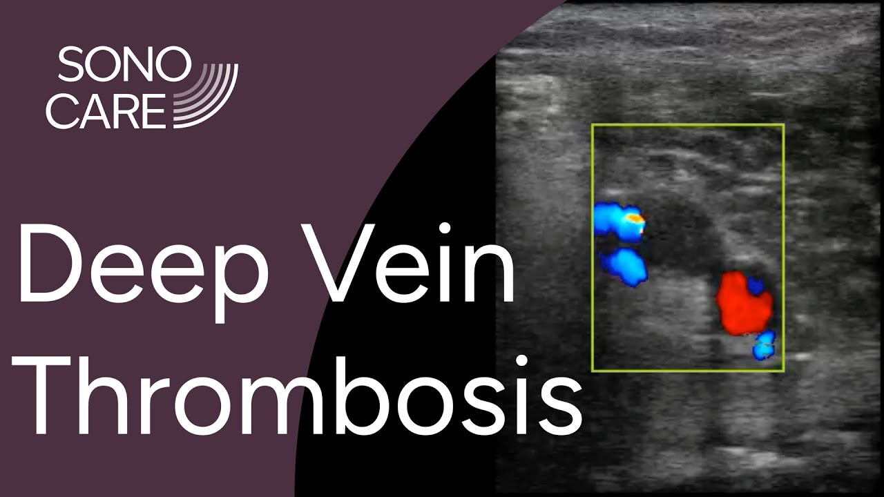 Deep Vein Thrombosis (DVT) Studies - YouTube