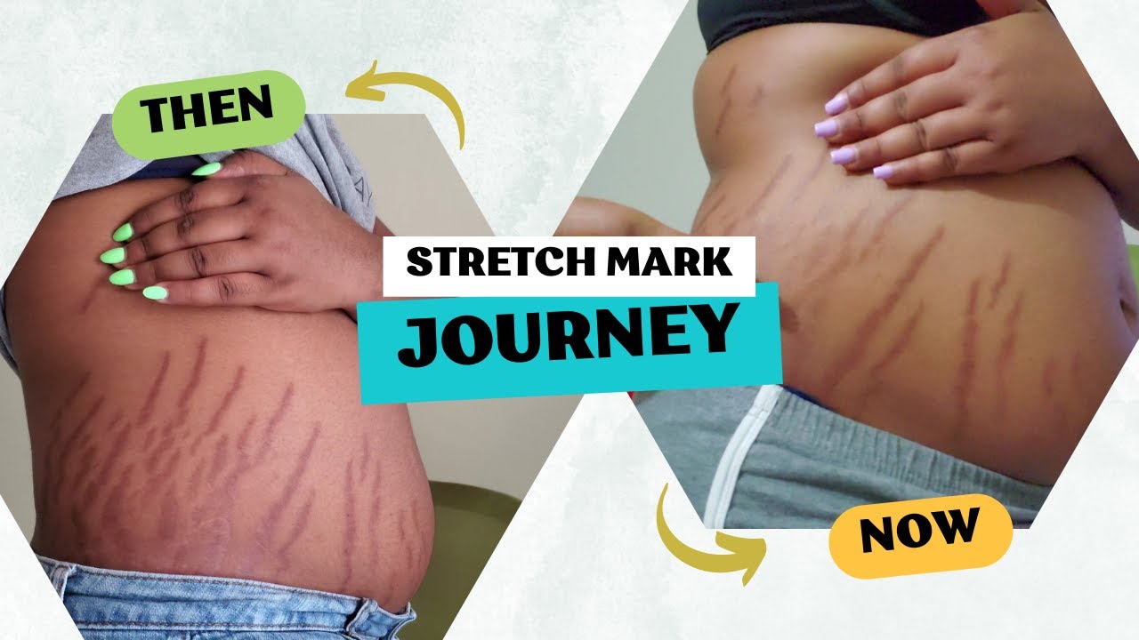 SAY GOODBYE TO STRETCH MARKS | RAW SHEA BUTTER | PART 4 | Hyacinth ...