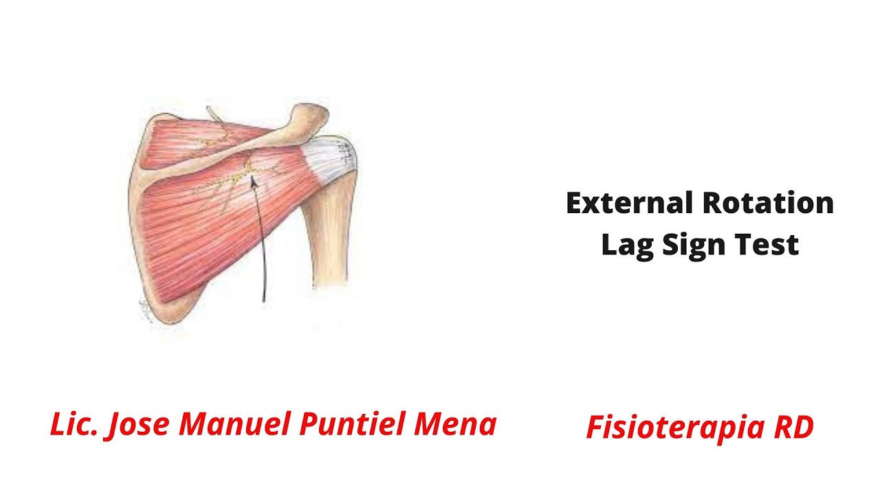 External Rotation Lag Sign - FisioterapiaRD (PF 38) - YouTube