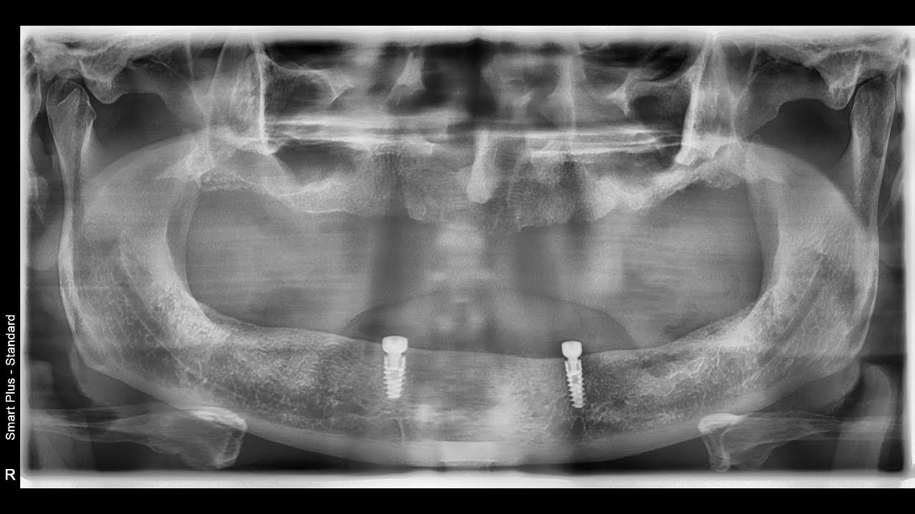 Implant Supported Denture using Ball & Socket - YouTube