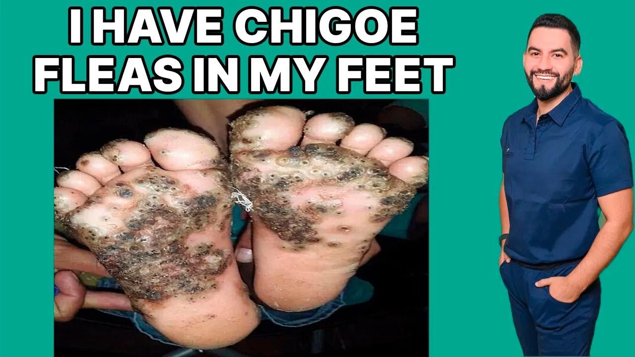 I Have a Flea Inside My Foot—Tungiasis Explained | Dr. David Campos ...