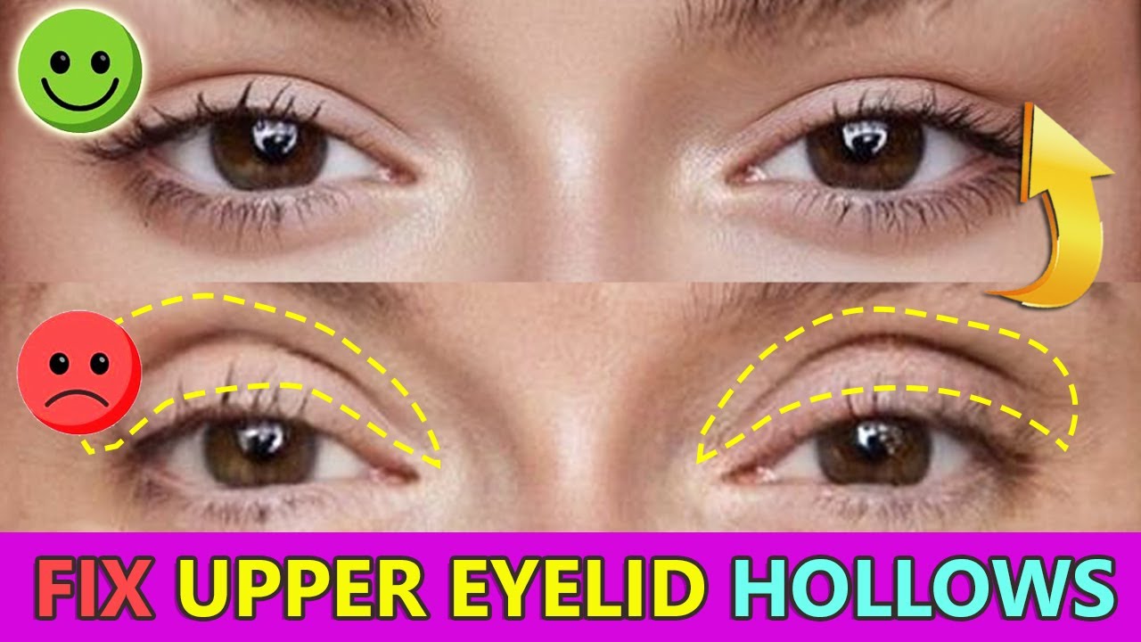BEST WAY to Fix Hollow Upper Eyelids, Upper Eyelids Plump and Lift ...