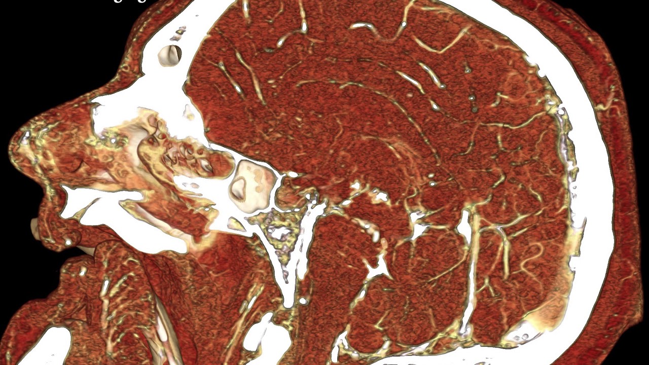 human cadaver head perfused with BriteVu MRI and CT - YouTube