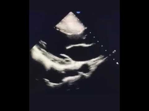 ASD bubble study echo - YouTube