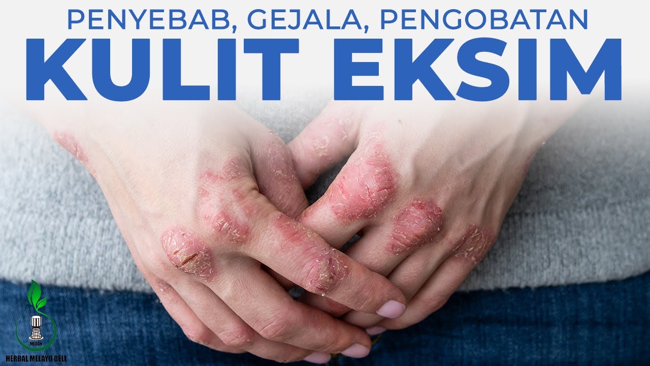 Cara Mengobati Penyakit Kulit Eksim (Dermatitis Atopik) || Penyebab ...