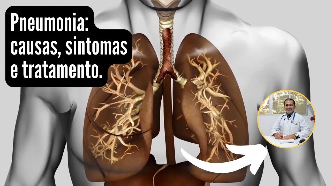 PNEUMONIA: CAUSAS, SINTOMAS E TRATAMENTO - YouTube