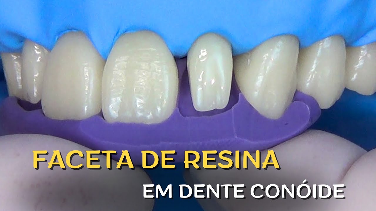 Como fazer faceta em dente conoide com barreira palatina - YouTube