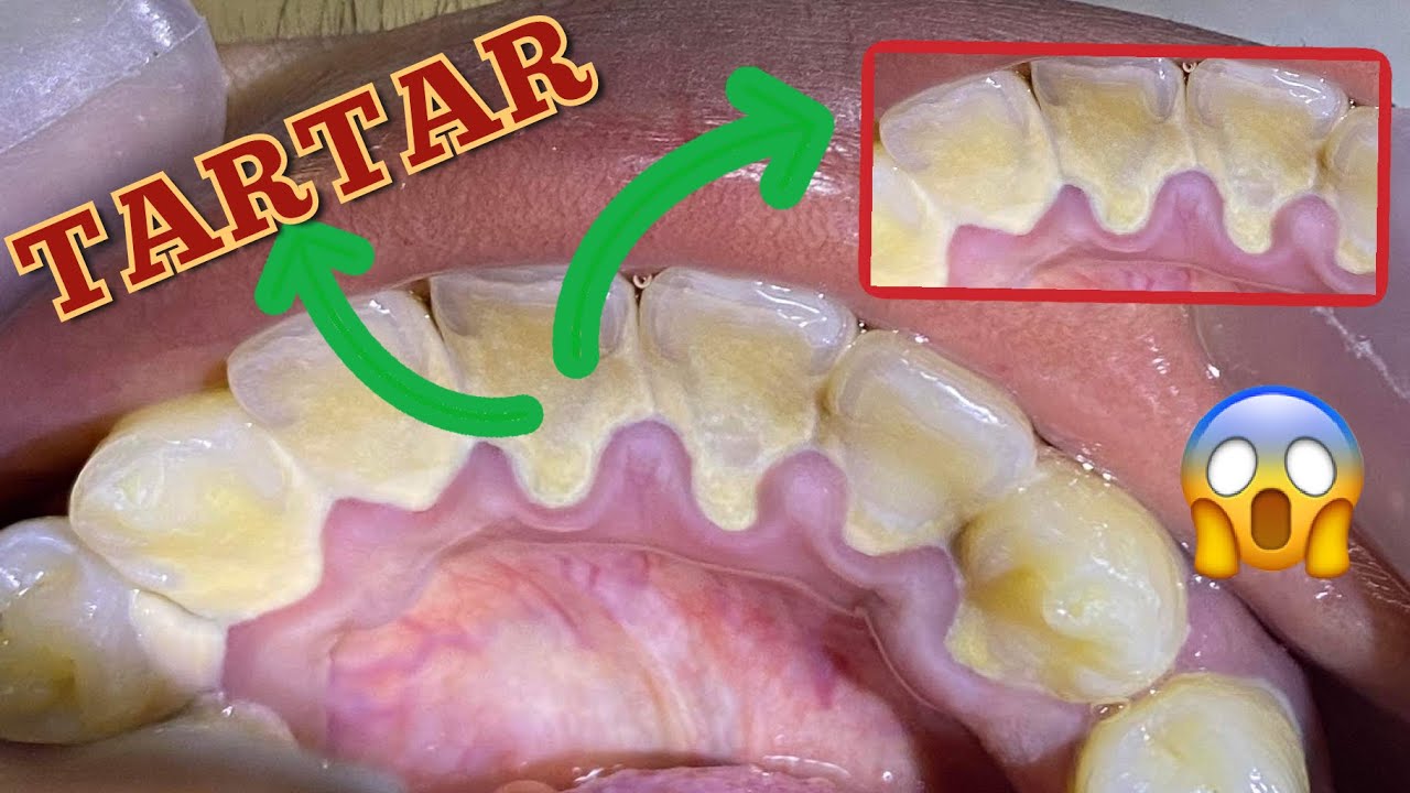 TOOTH CLEANING// HEAVY TARTAR - YouTube