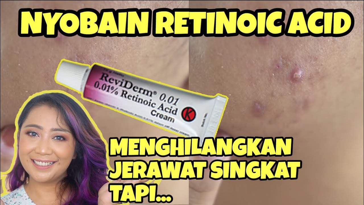 KRIM AMPUH UNTUK MENGHILANGKAN JERAWAT RETINOIC ACID!! PERTAMA KALI ...
