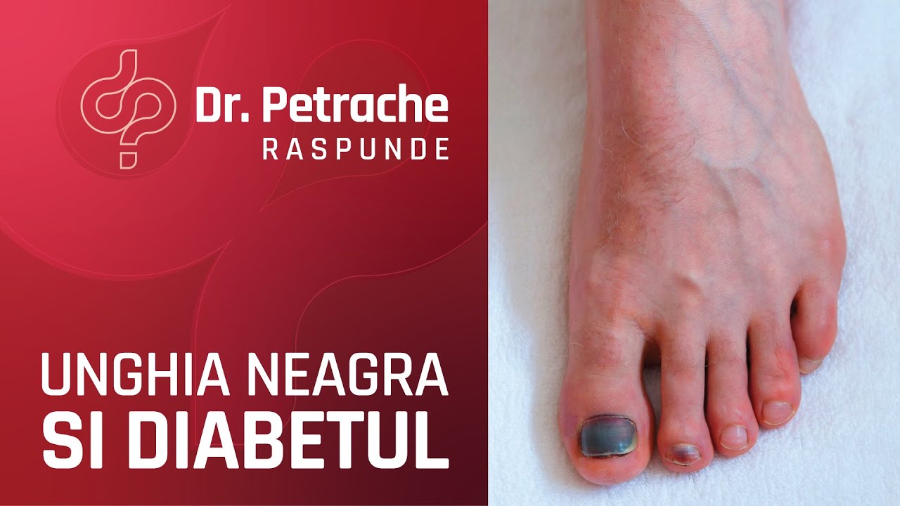 AM O UNGHIE NEAGRA LA PICIOR, CE SA FAC? - YouTube