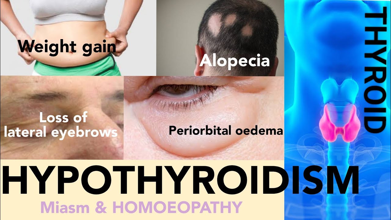 HYPOTHYROIDISM( थायराइड ) & homoeopathic(MIASM) Dr.Sairal - YouTube
