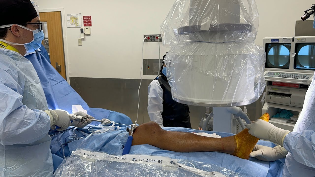 Suprapatellar tibia nailing technique - YouTube