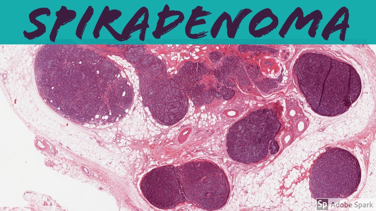 Spiradenoma 5 Minute Pathology Pearls Youtube