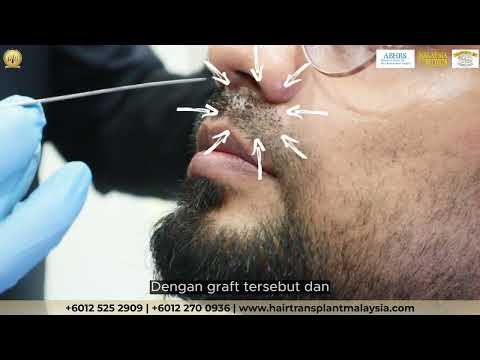 TANAM MISAI SELEPAS KEMALANGAN | HAIR TRANSPLANT MALAYSIA | KLINIK TANAM RAMBUT DI MALAYSIA