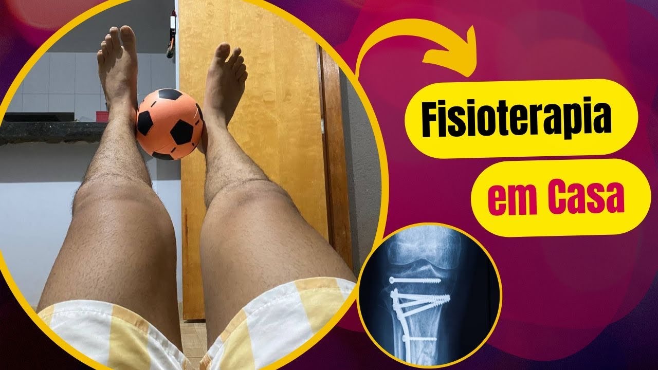 Fratura De Platô Tibial Fisioterapia - RETOEDU
