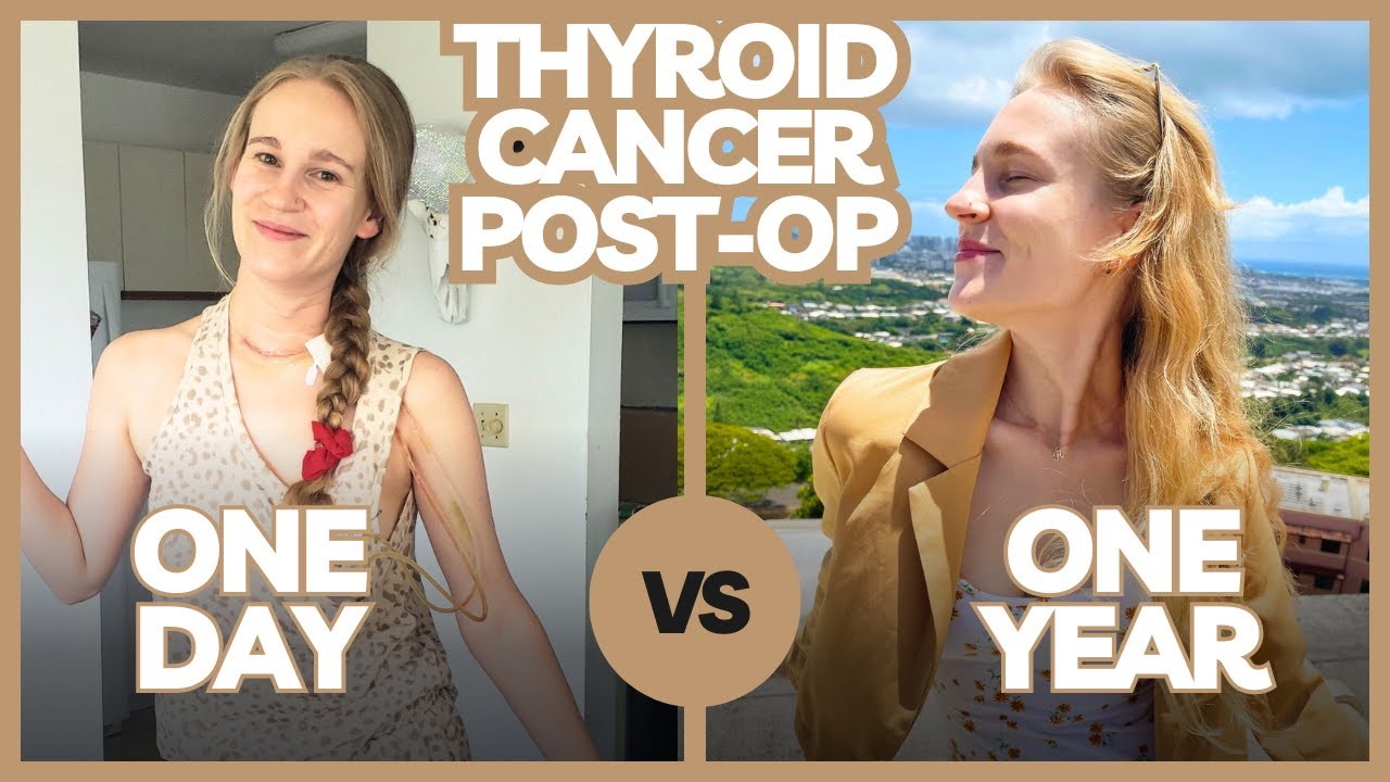 One Year Post Thyroidectomy and Dissection for Papillary Thyroid Cancer ...