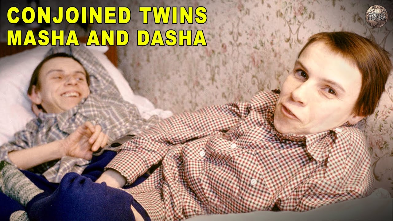 How Conjoined Twins Ended Up Taking Very Different Life Paths - YouTube