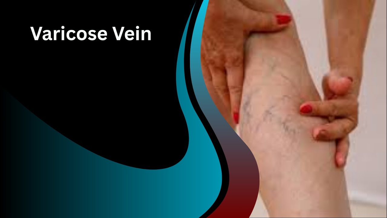 Varicose Vein || CEAP Classification|| Vein disorder 2/2 || Surgery ...