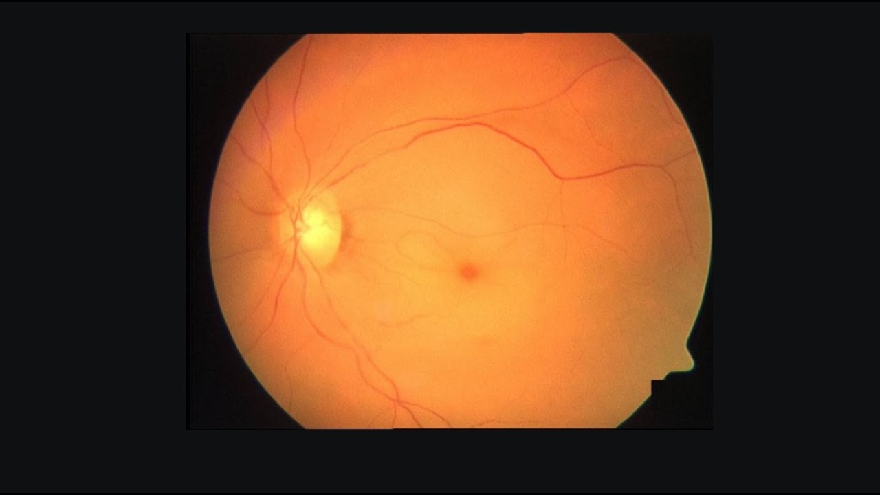 Central Retinal Artery Occlusion （CRAO）and Its Impact on the Optic ...