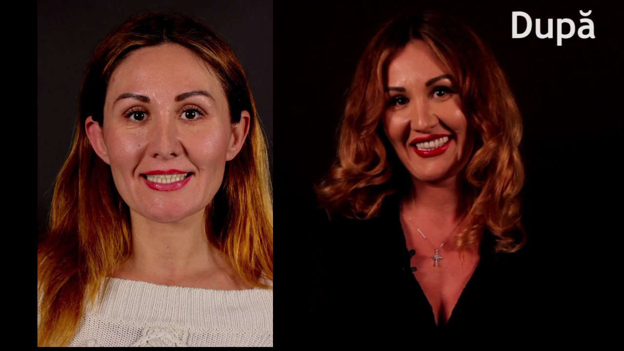 Before&After cu fatete dentare la DENT ESTET - YouTube